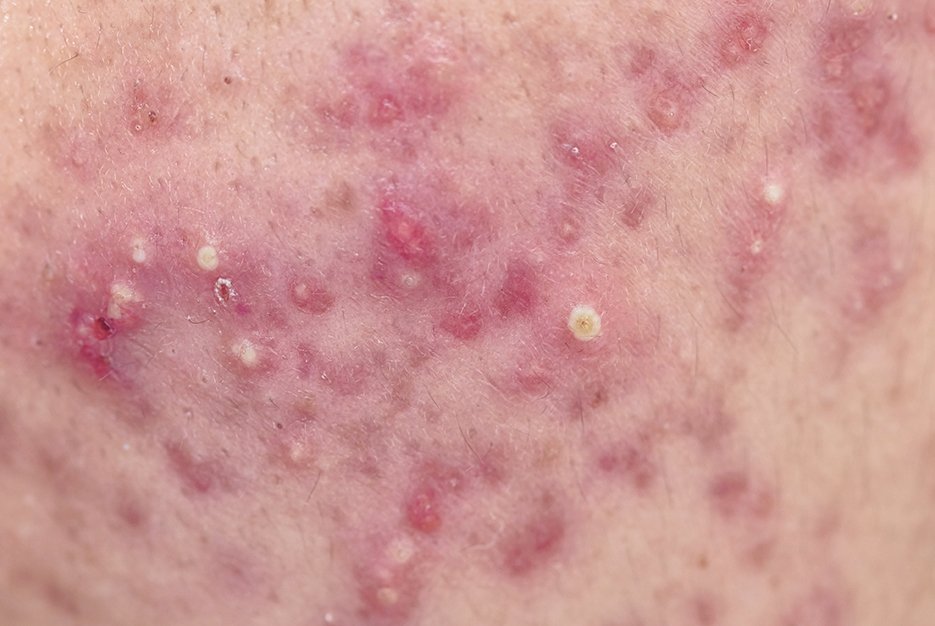 Evidence-based approaches to treating acne vulgaris - Medical Independent