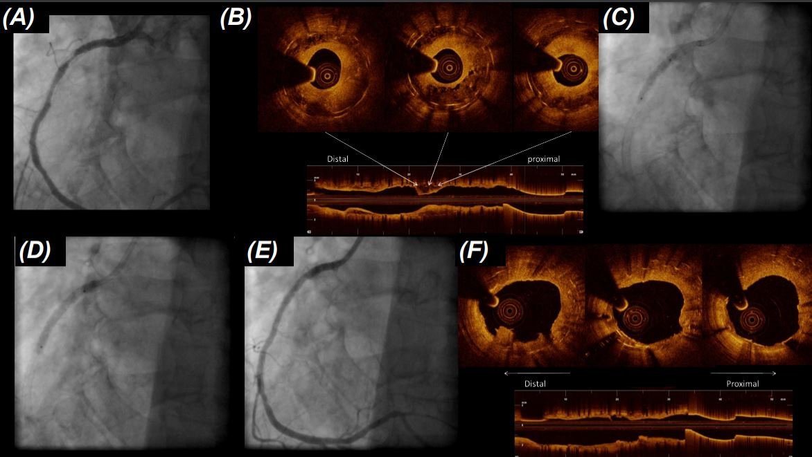 Management of in-stent restenosis - Medical Independent