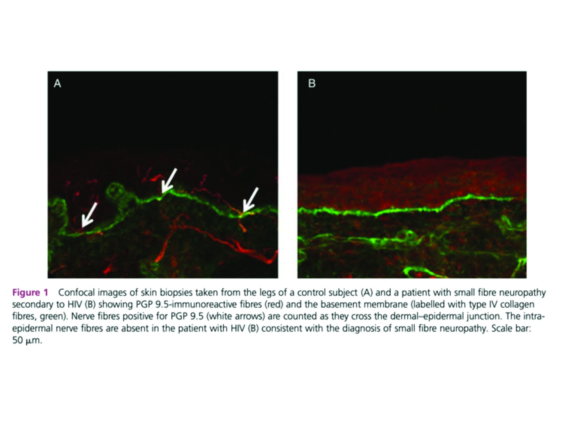 Diagnosing and managing painful small fibre neuropathy - Medical ...