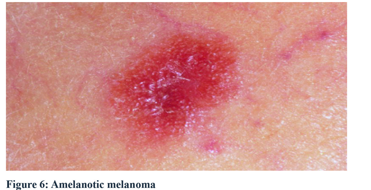 Melanoma: An overview - Medical Independent