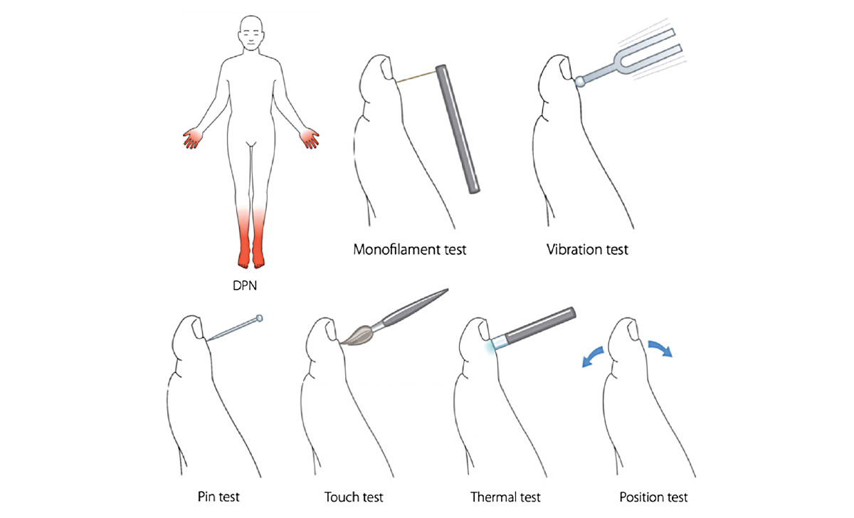 Management of painful diabetic neuropathy: 2022 and beyond - Medical ...
