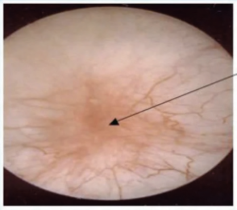 Bladder pain syndrome/ interstitial cystitis - Medical Independent