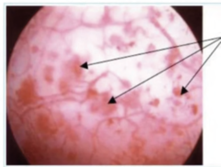 Bladder pain syndrome/ interstitial cystitis - Medical Independent