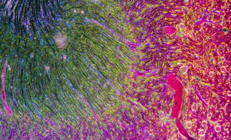 Fibromuscular dysplasia under the microscope - Medical Independent