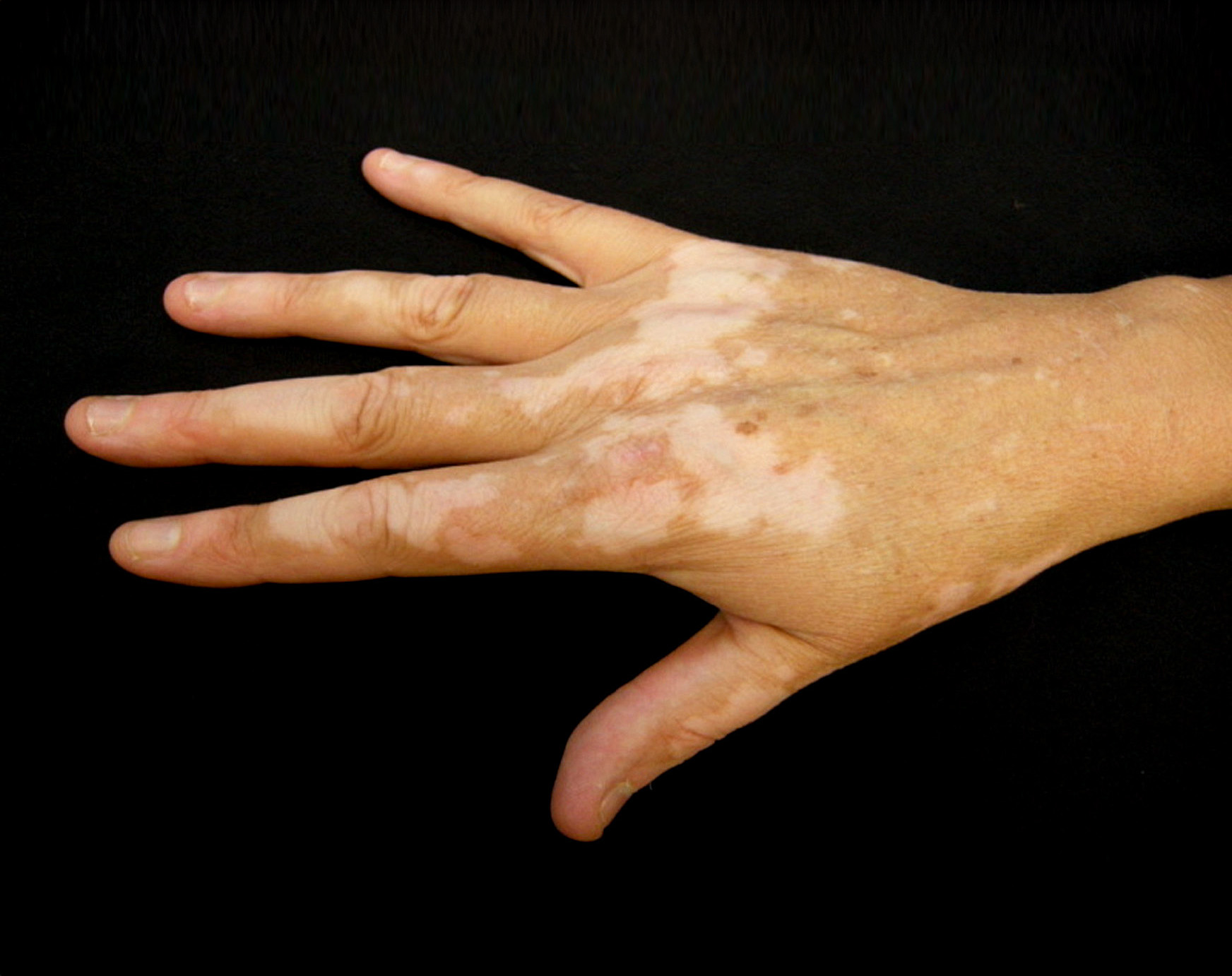 In focus: Vitiligo - Medical Independent