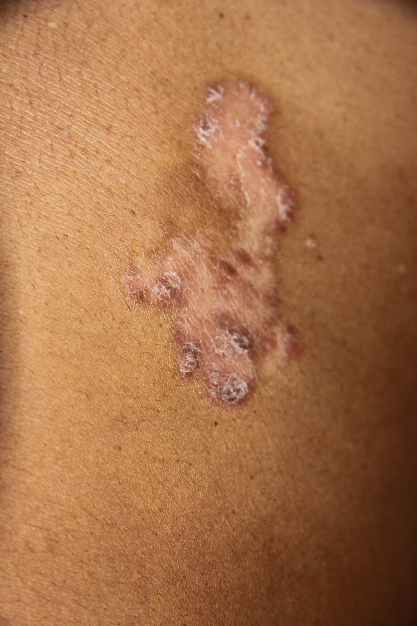 Psoriasis in primary care - Medical Independent