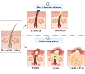 In focus: Acne - Medical Independent