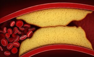 Cholesterol in focus - Medical Independent