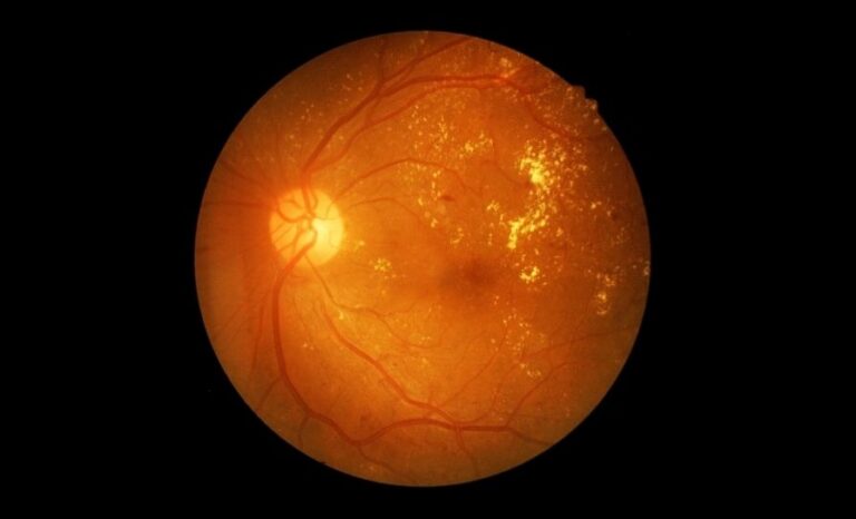 Diabetic RetinaScreen: Demand continuing to grow - Medical Independent
