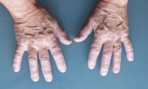 New EULAR guidelines on systemic sclerosis - Medical Independent