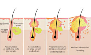 Managing acne in 2025: An expert overview of the latest approaches ...