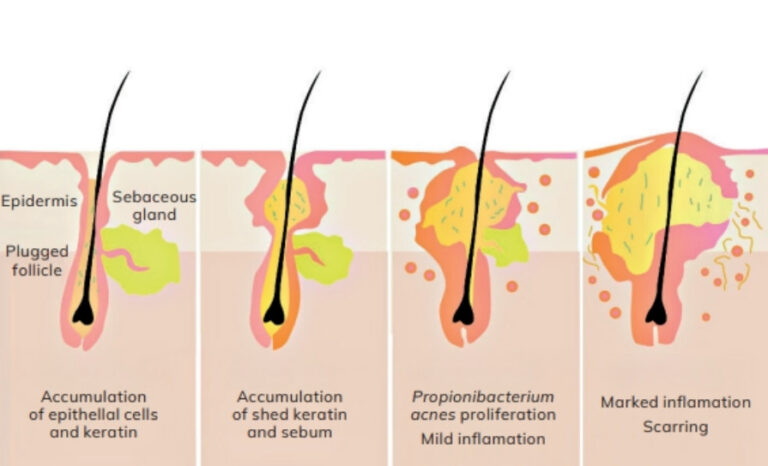 Managing acne in 2025: An expert overview of the latest approaches ...