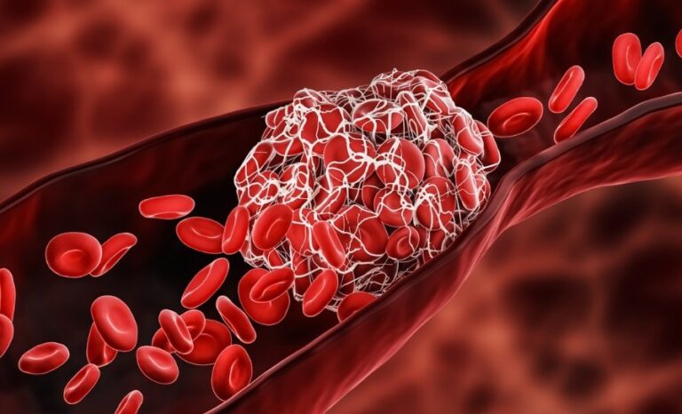 Eve’s Protocol launched to optimise care of patients with VTE in ...