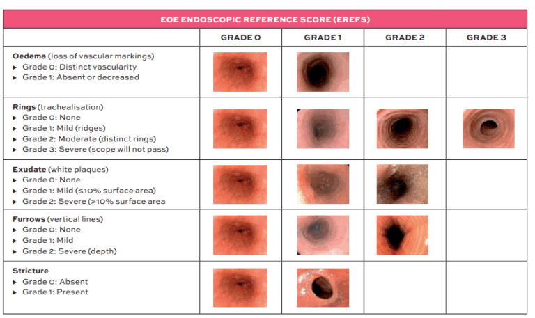 Eosinophilic oesophagitis - Medical Independent